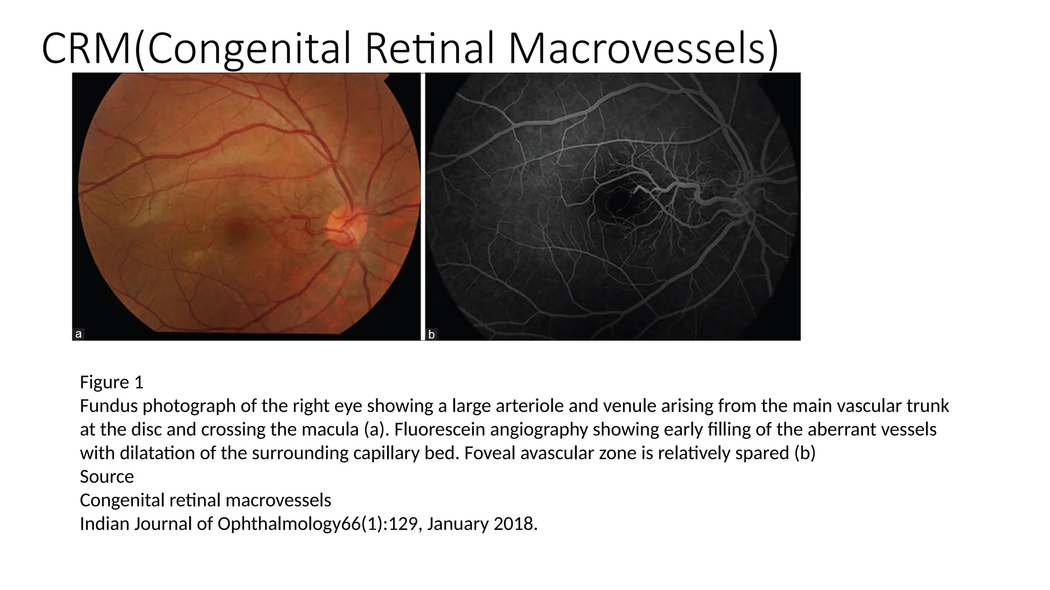 Blood supply of retina, optic nerve head | PPTX