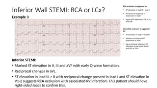 Blood Supply of SA and AV Nodes and Inferior Wall MI.pptx