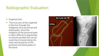 Blood supply of scaphoid and scaphoid fractures.pptx