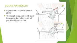 Blood supply of scaphoid and scaphoid fractures.pptx