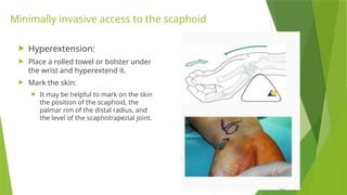 Blood supply of scaphoid and scaphoid fractures.pptx