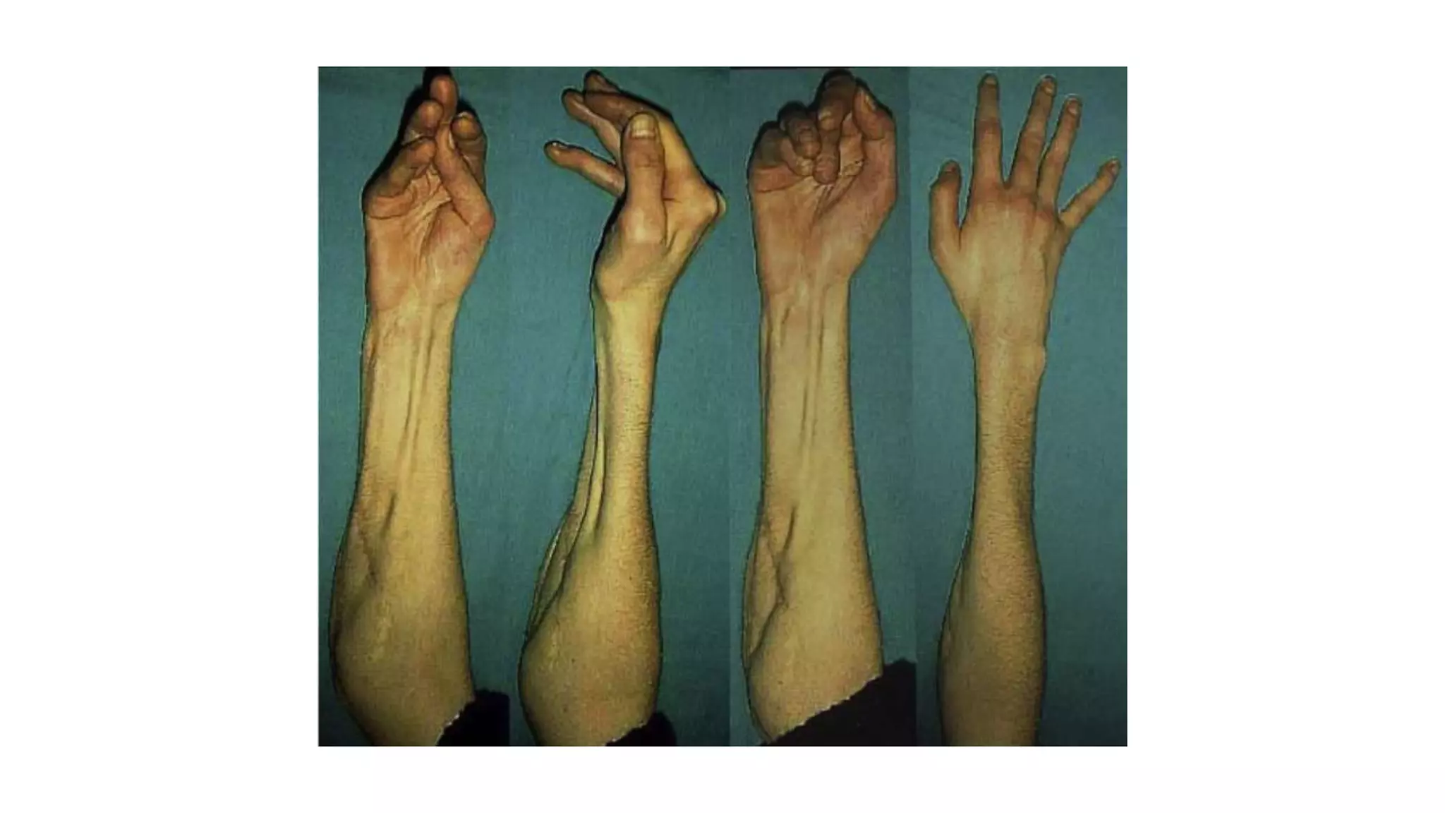 Blood vessels of Upper Limb.pptx