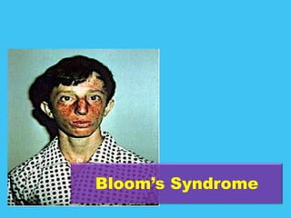 Bloom Syndrome: Rare Genetic Disorder Causing Short Stature, Cancer ...