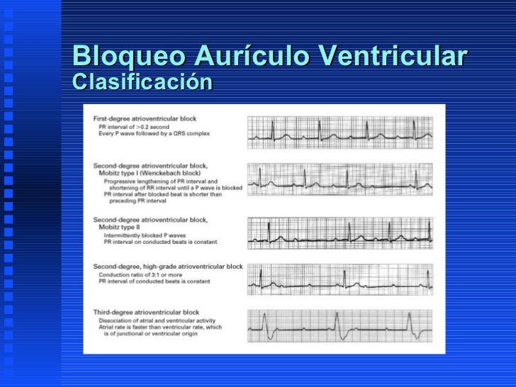 Tercer Grado Bloqueo Auriculoventricular at Mazie Reed blog