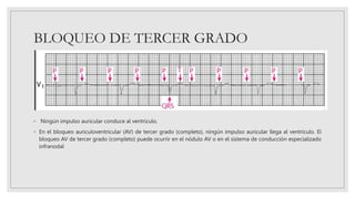 BLOQUEO AURICULOVENTRICULAR.pptx