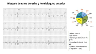 bloqueo-auriculoventricularcular-pptx