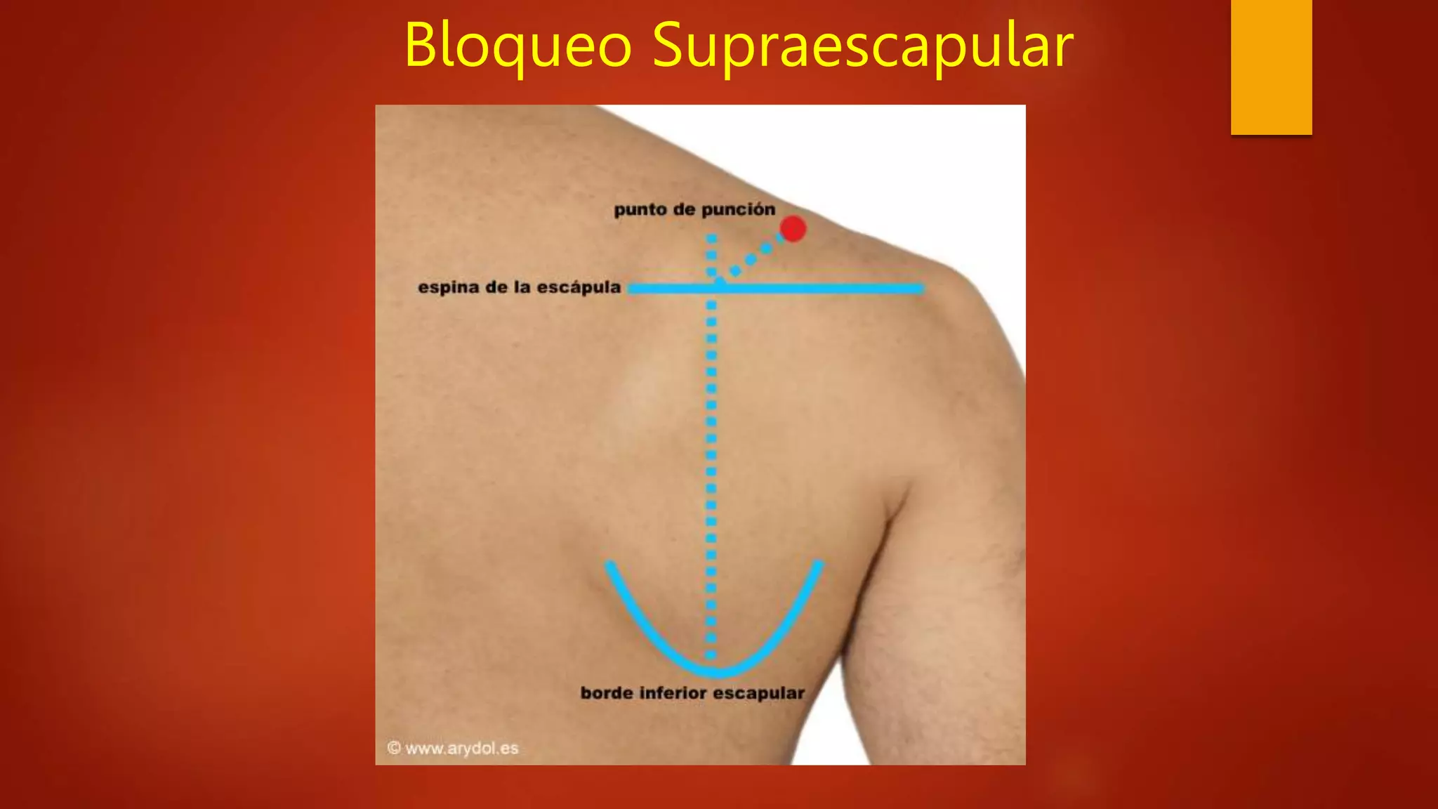 BLOQUEO INTERESCALENICO SUPRACLAVICULAR Y SUPRAESCAPULAR.pptx