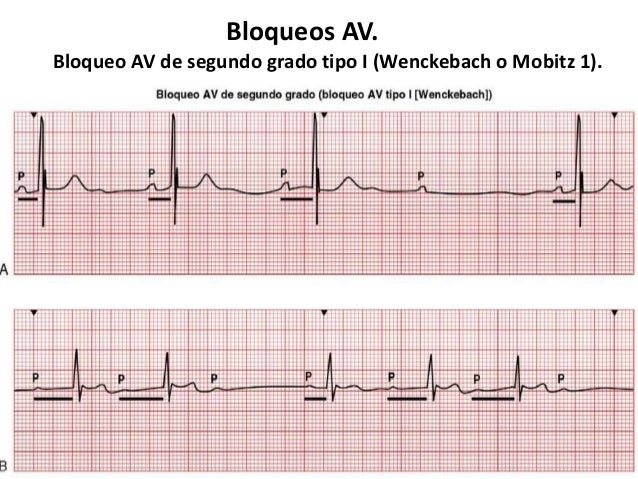 Bloqueos aurículoventriculares
