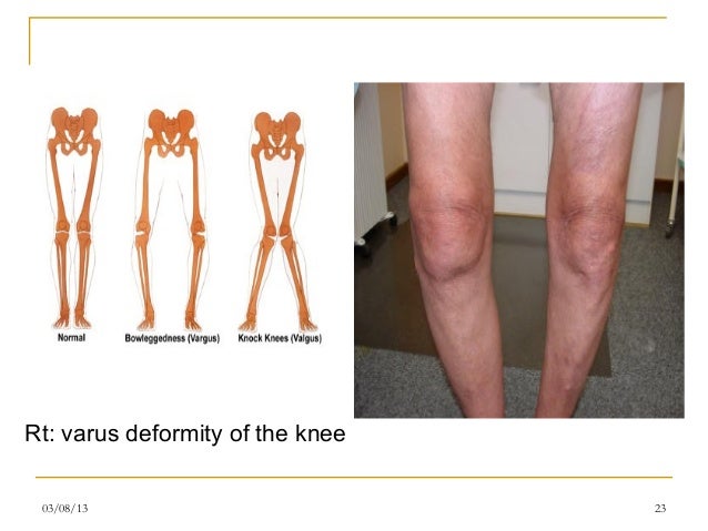 osteoartheritis