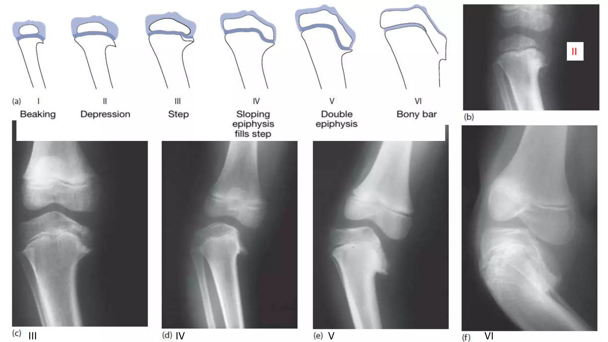 blount disease pptx | PPTX
