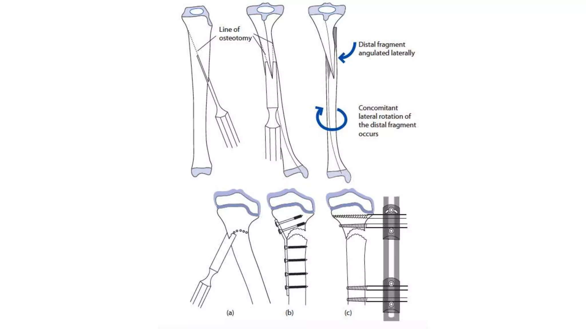 blount disease pptx | PPTX