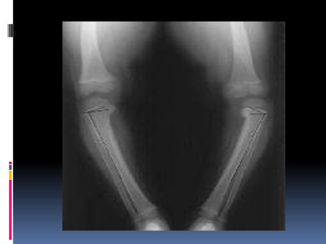 Blounts disease | PPTX | Bone and Joint Conditions | Diseases and ...