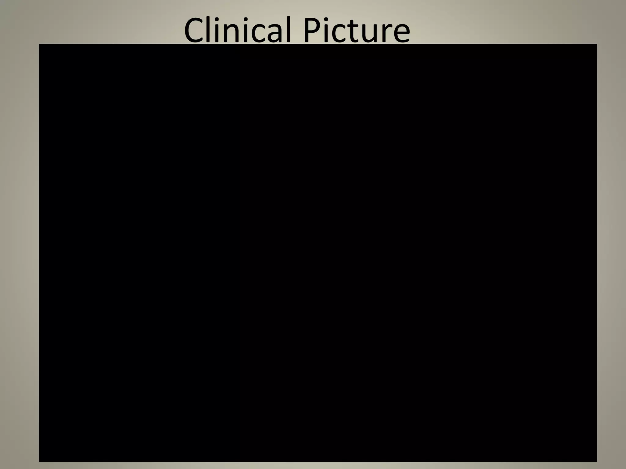 Blounts disease | PPTX