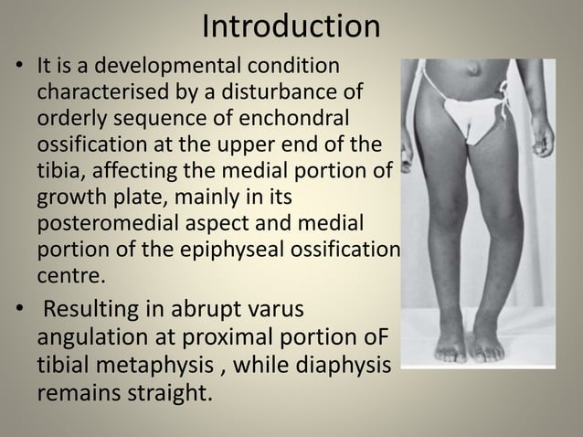 Blounts disease | PPTX