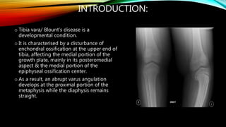 Blounts disease | PPTX
