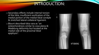 Blounts disease | PPTX
