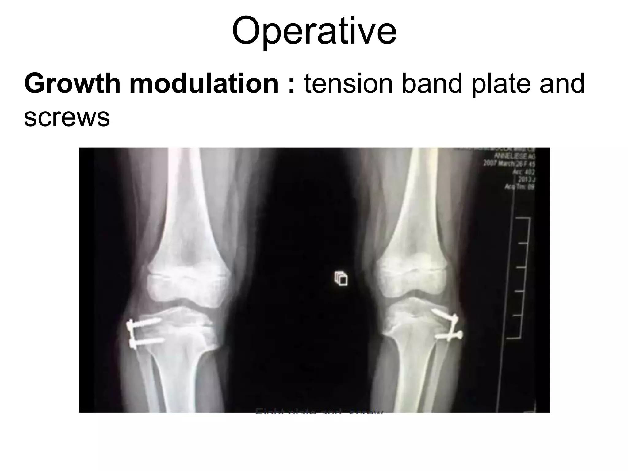 BLOUNT’S DISEASE.pptx