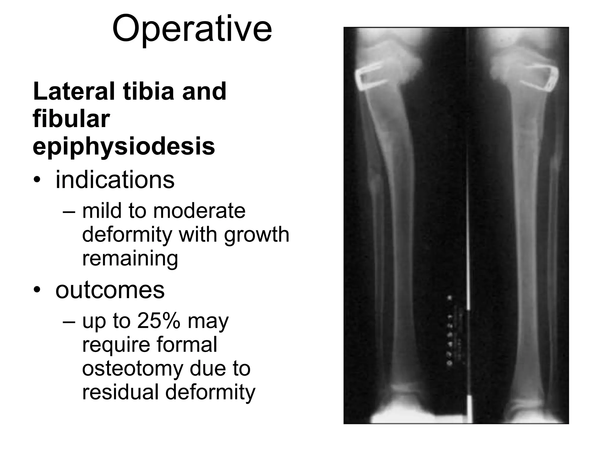BLOUNT’S DISEASE.pptx