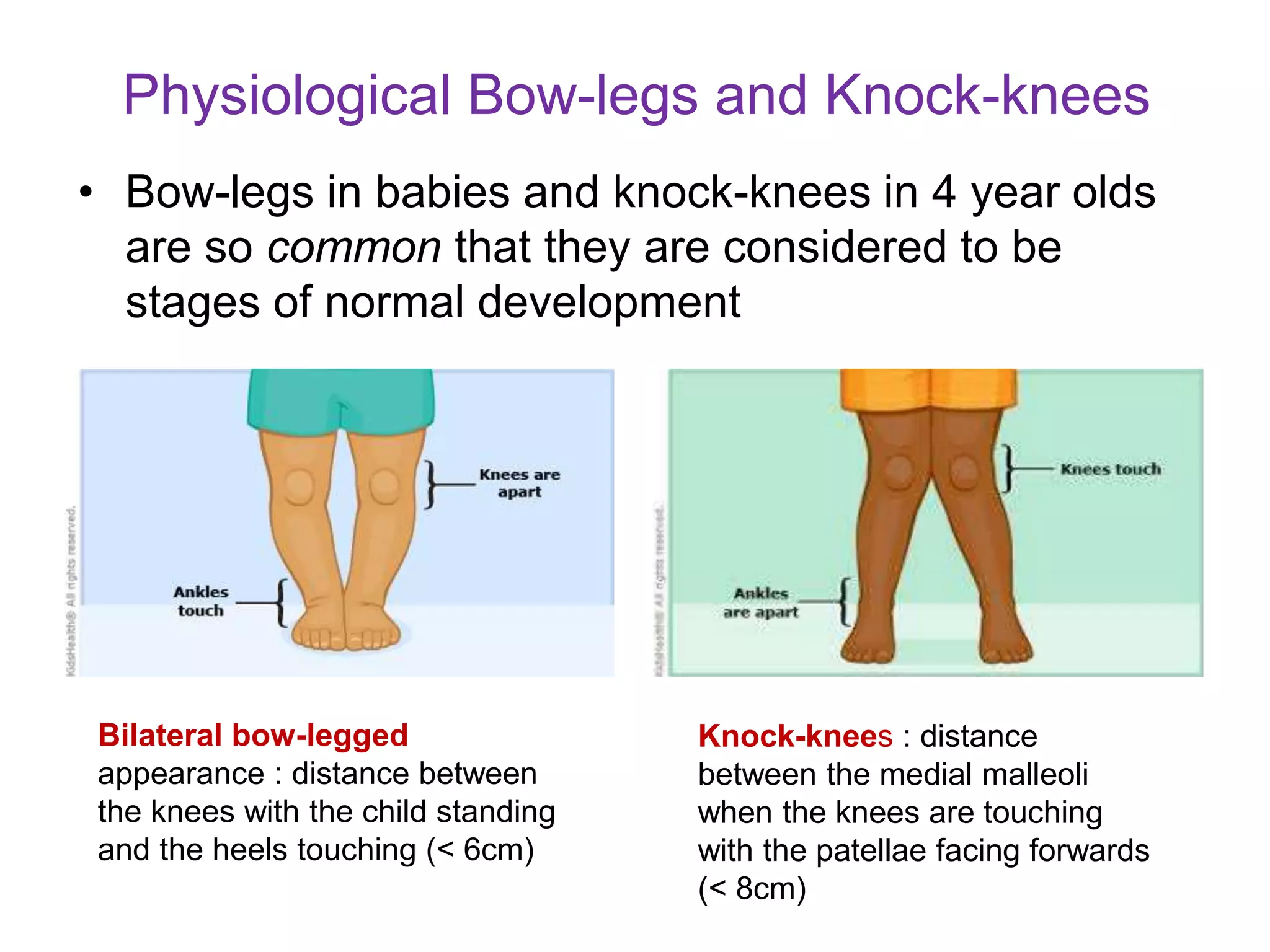 BLOUNT’S DISEASE.pptx
