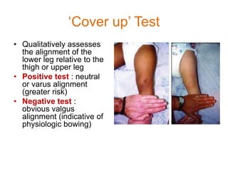 BLOUNT’S DISEASE.pptx