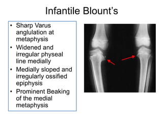 BLOUNT’S DISEASE.pptx