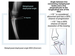 BLOUNT’S DISEASE.pptx