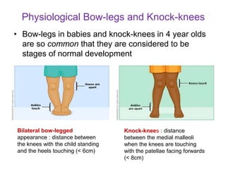 BLOUNT’S DISEASE.pptx