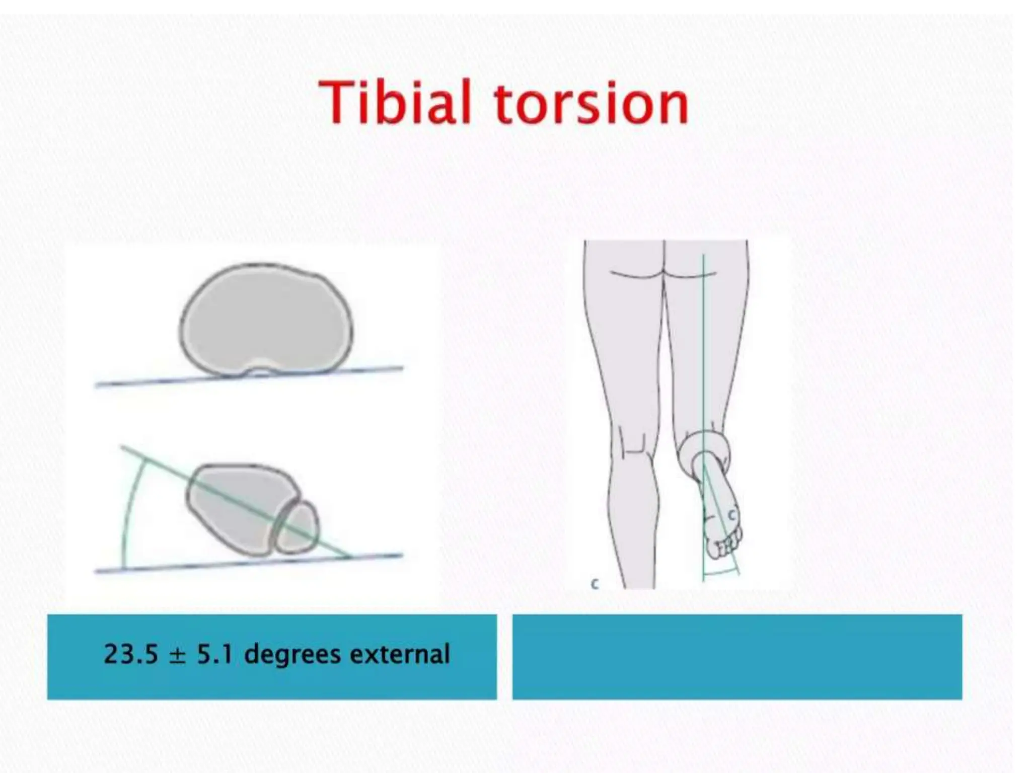 blounts disease.pptx