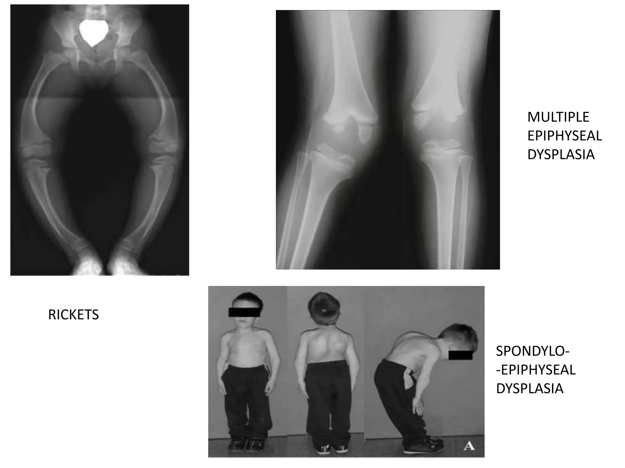 blounts disease.pptx