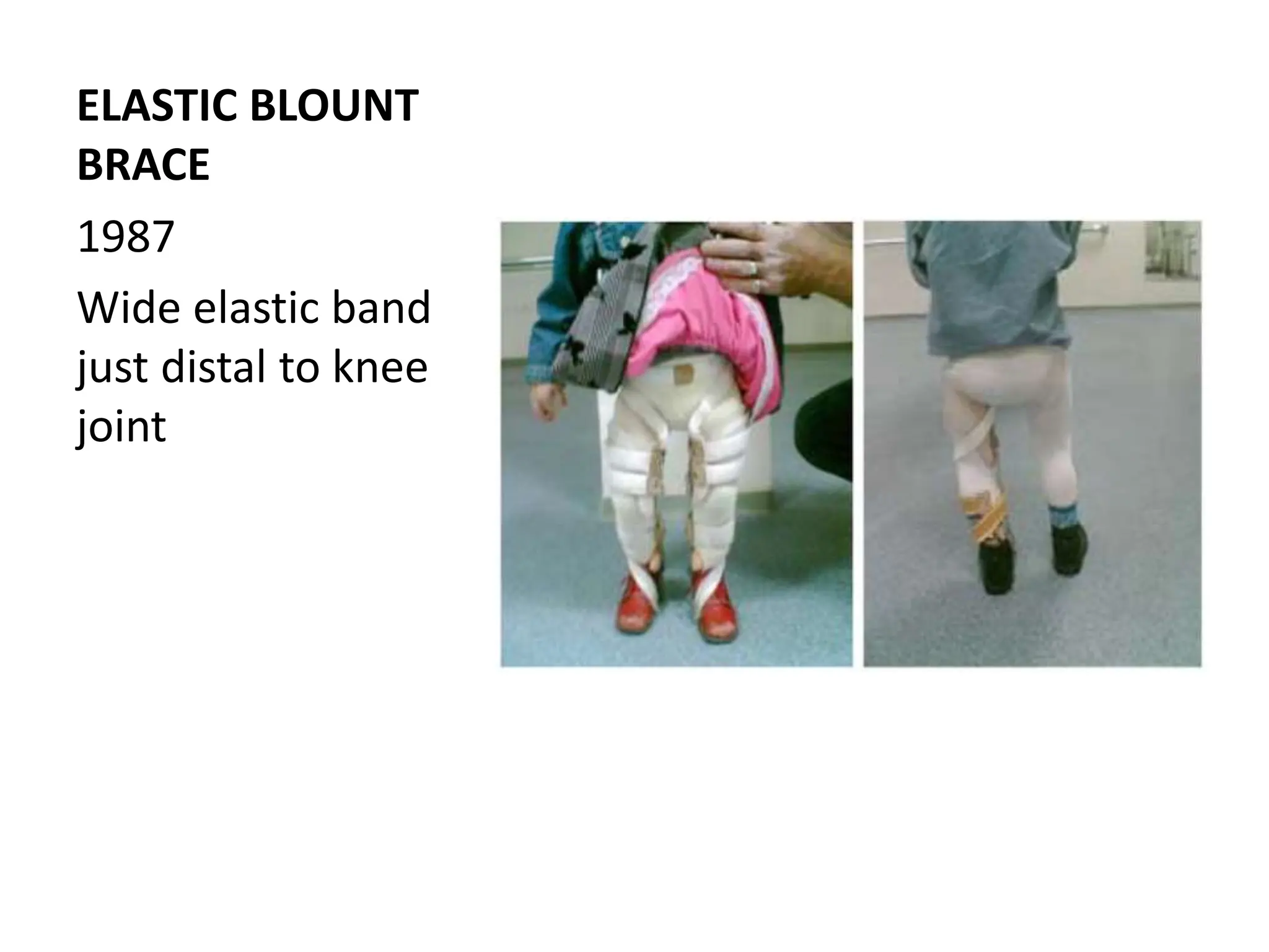 blounts disease.pptx