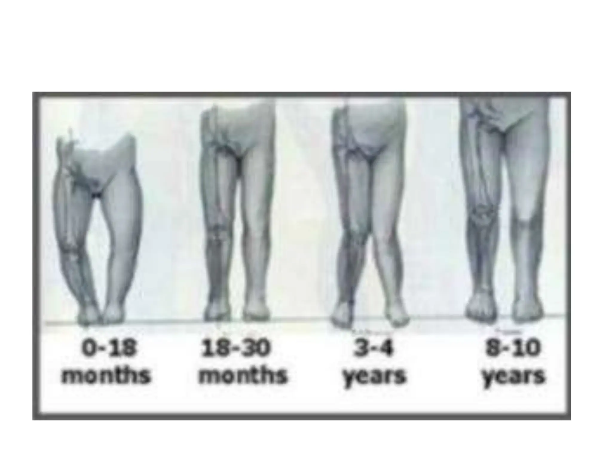 blounts disease.pptx