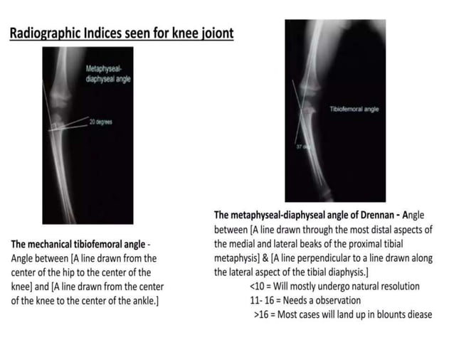 blounts disease.pptx | Death, Injury, or Military Conflict | Sensitive ...