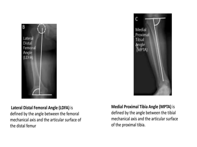 blounts disease.pptx | Death, Injury, or Military Conflict | Sensitive ...