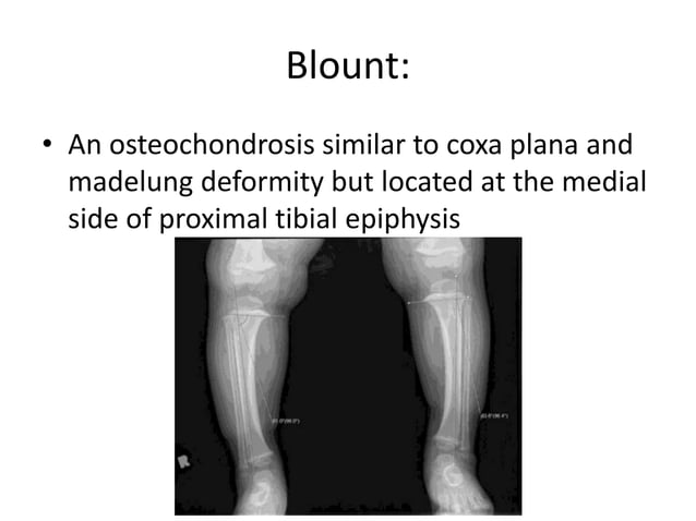 blounts disease.pptx | Death, Injury, or Military Conflict | Sensitive ...