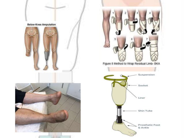Blow knee amputation 1 | PPT