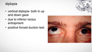 BLOW OUT FRACTURE.pptx