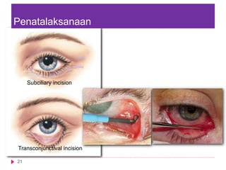 BLOW OUT FRACTURE.pptx