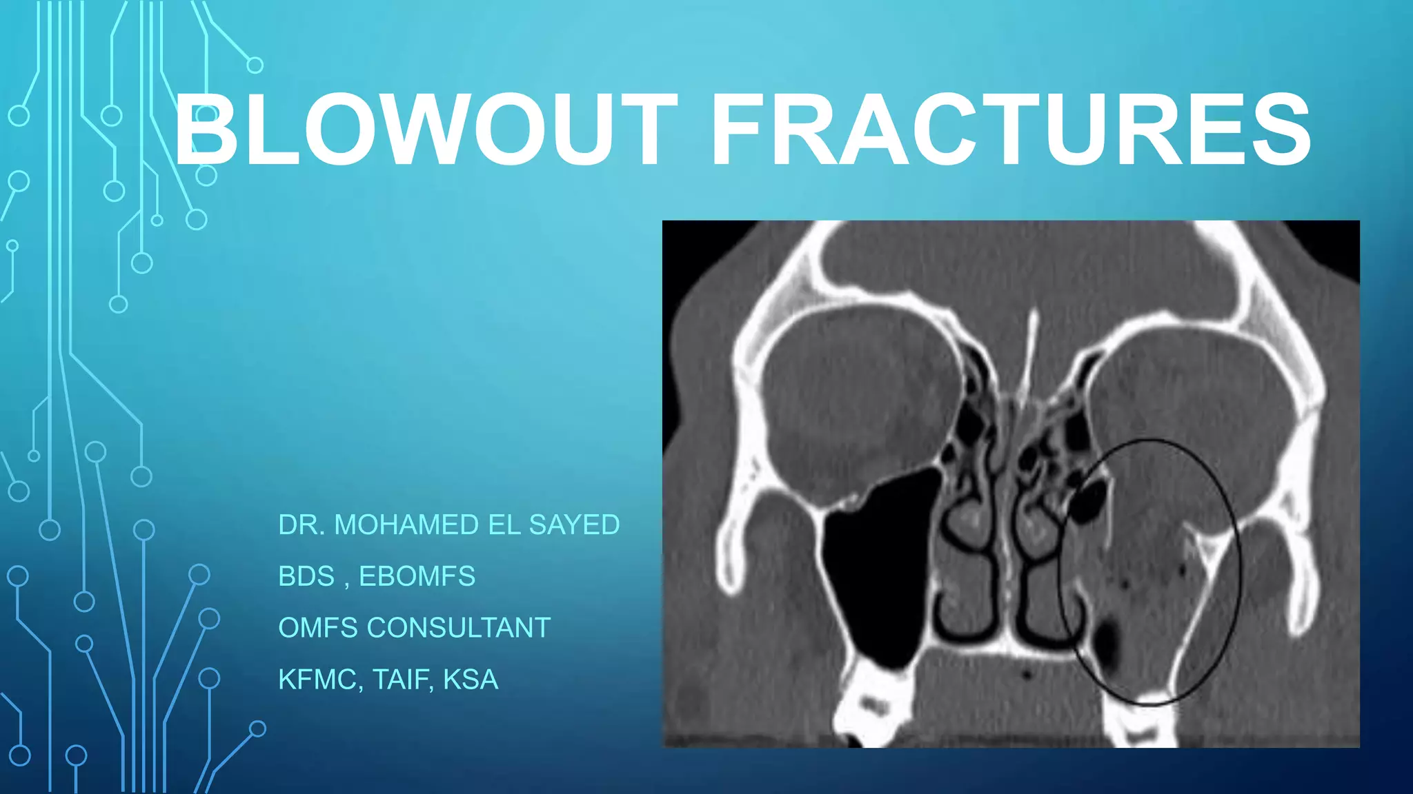 Blowout fractures | PPTX | Death, Injury, or Military Conflict ...