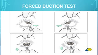 Blowout fractures | PPTX | Death, Injury, or Military Conflict ...