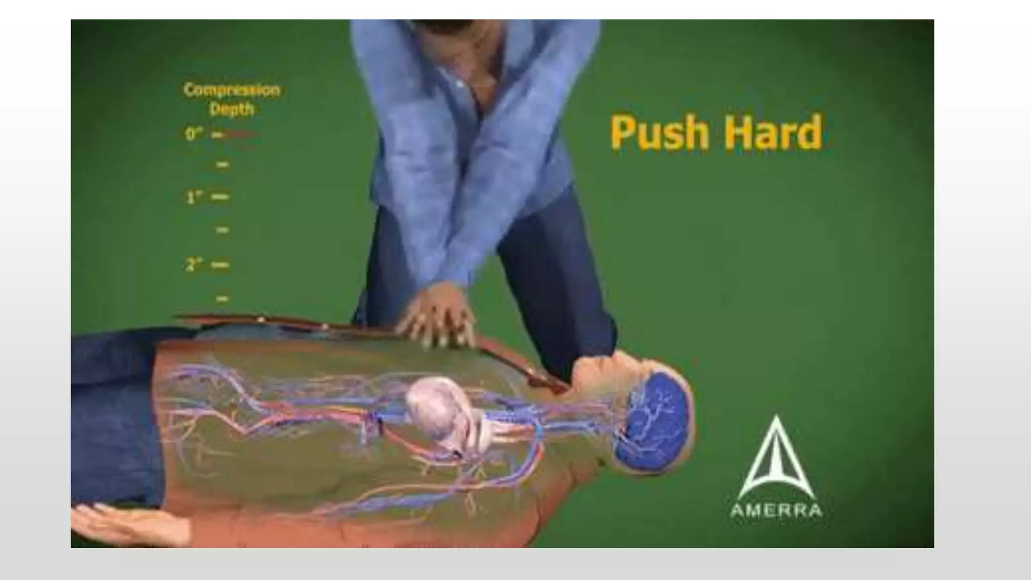 BASIC LIFE SUPPORT BLS & CPR | PPTX