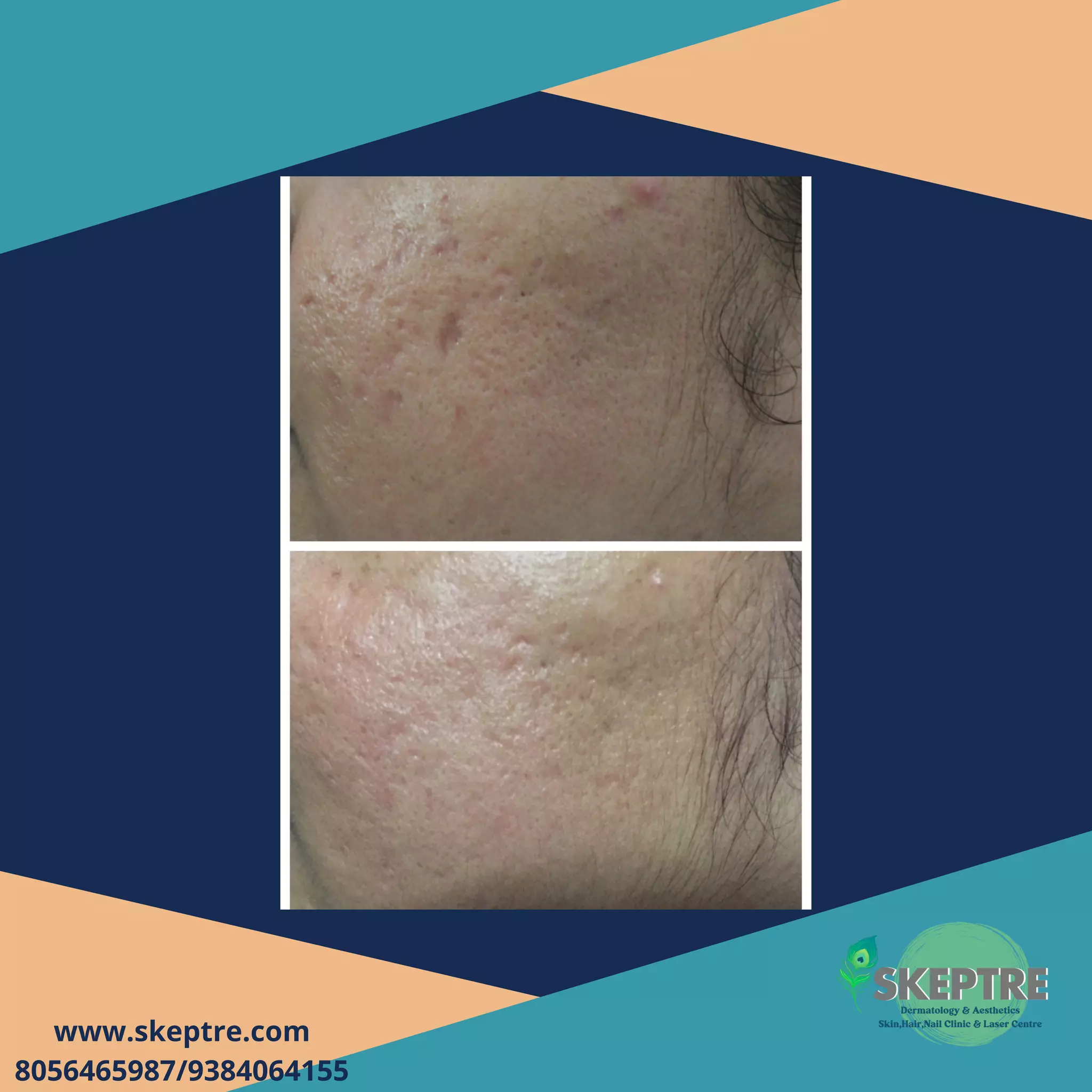 SCARS TREATMENTS | PDF