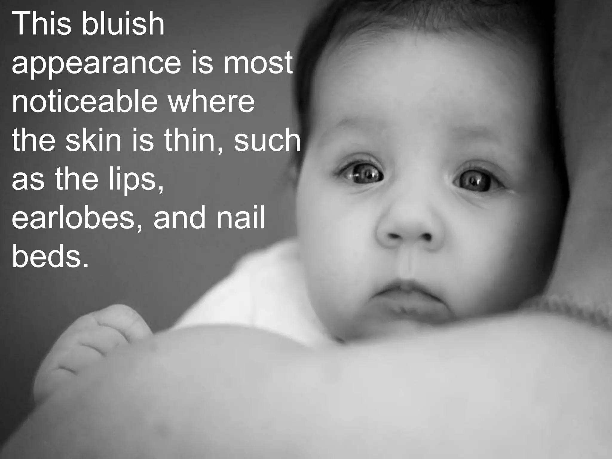 Blue Baby Syndrome - A Hope Under THE BLUE | PPTX