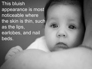 Blue Baby Syndrome - A Hope Under THE BLUE | PPTX