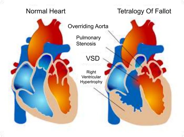 Blue Baby Syndrome - A Hope Under THE BLUE
