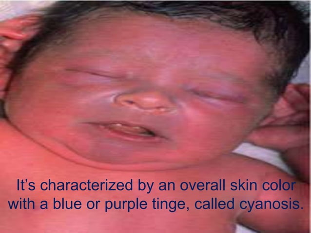 Blue Baby Syndrome - A Hope Under THE BLUE