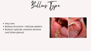 Oral Lichen Planus| Diagnosis, Treatment and Management | PDF