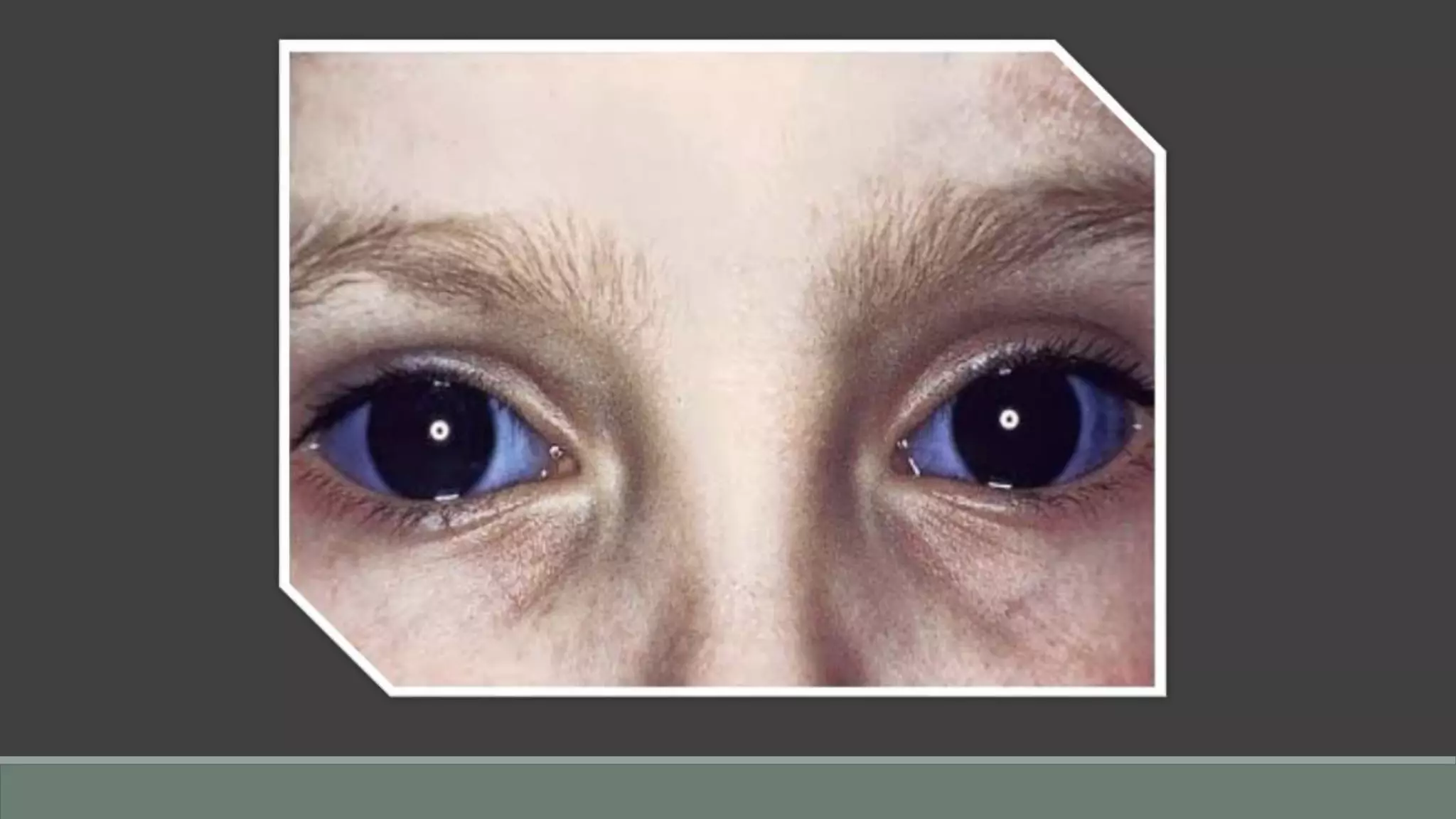 blue sclera.pptx