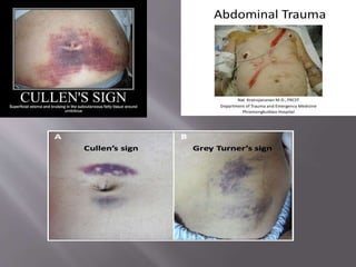 Blunt Abdominal Trauma | PPT