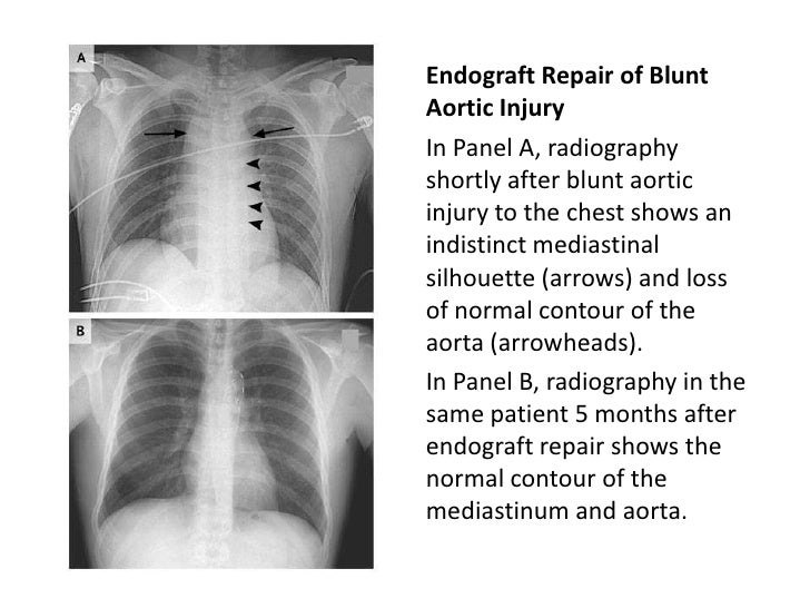 Blunt Aortic Injury