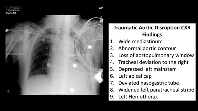EMGuideWire's Radiology Reading Room: Blunt Aortic Injury | PPTX